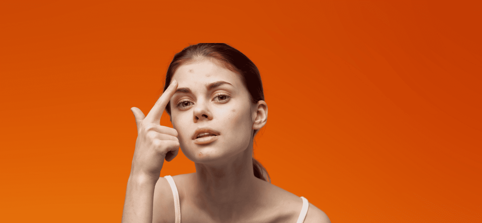 Acne no rosto: o que é e como tratar | Darrow